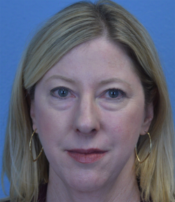 Reno Blepharoplasty Before and After Photos - Carson City Plastic ...